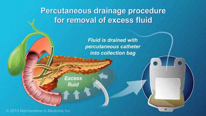 Management and Treatment of Acute Pancreatitis